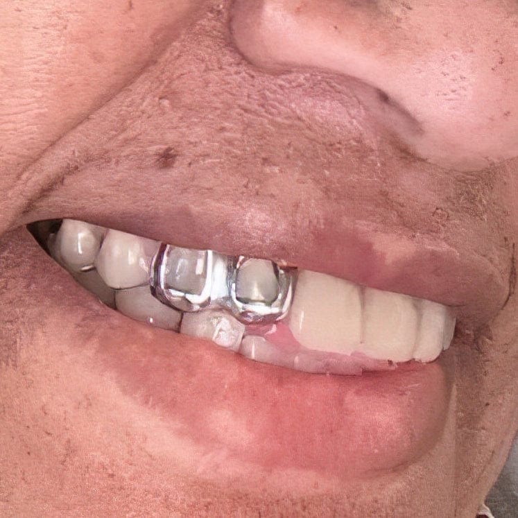 925 Sterling Silver Double Side Canine Open Face Caps Custom Grillz