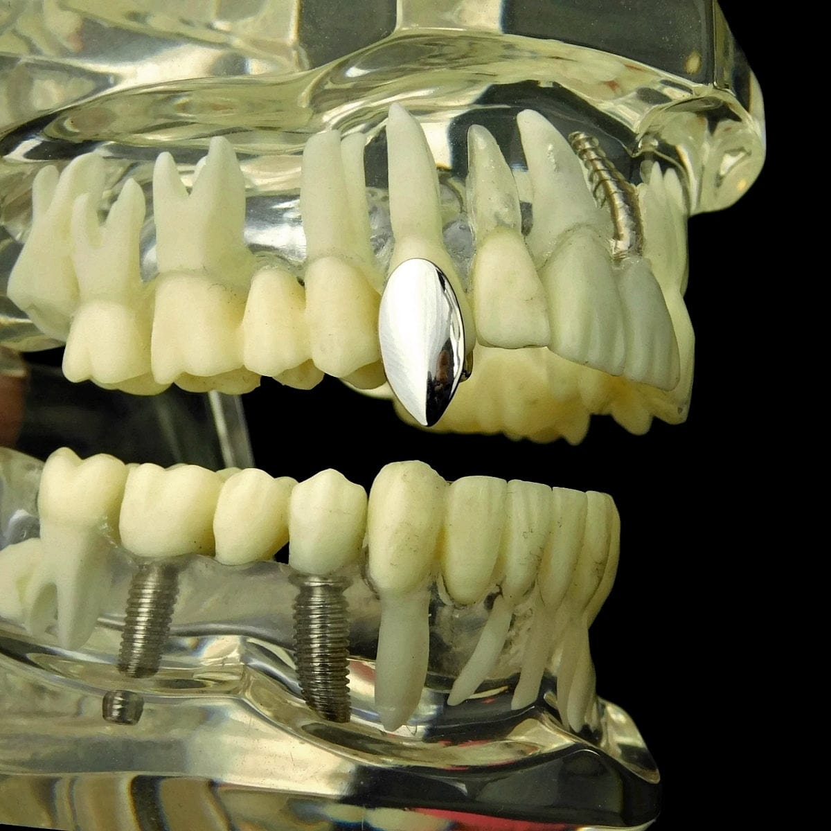 Silver Tone Vampire Fang Top Canine Tooth Cap