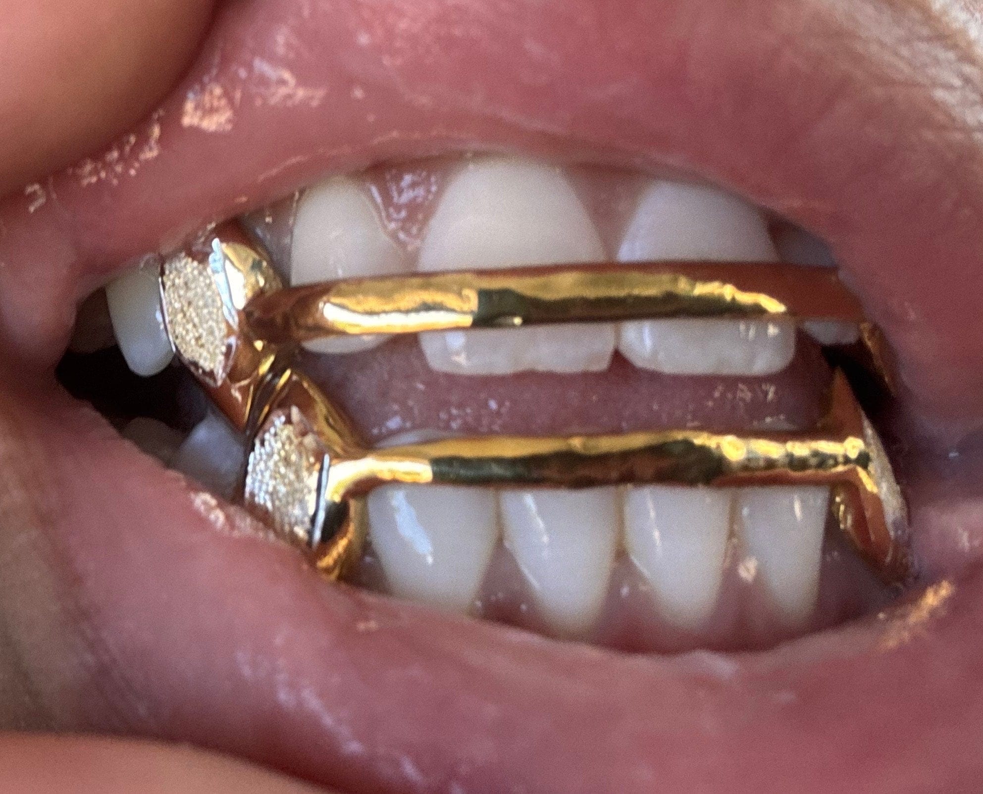 10k Gold Diamond Dust Fang Custom Grillz – Bling Cartel